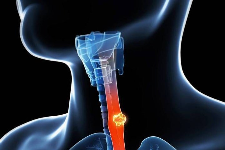 Waspada, Ketahui 7 Penyakit Mematikan yang Disebabkan oleh Asap Rokok